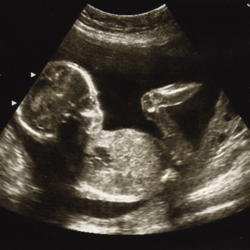 Beda USG 2D, 3D, dan 4D yang Harus Diketahui Tiap Ibu Hamil